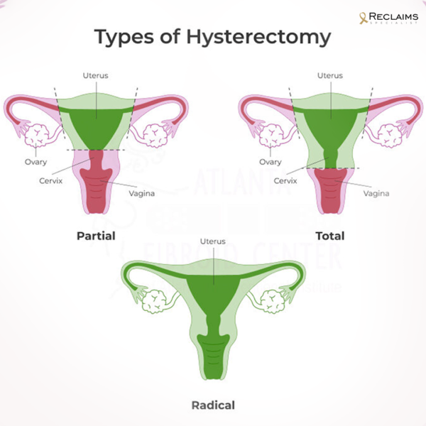 The Essential Guide to Partial Hysterectomy Surgery